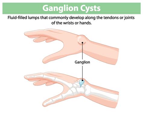 Ganglion Cyst Wrist Ganglion Cyst Grip Hand And Wrist Surgery