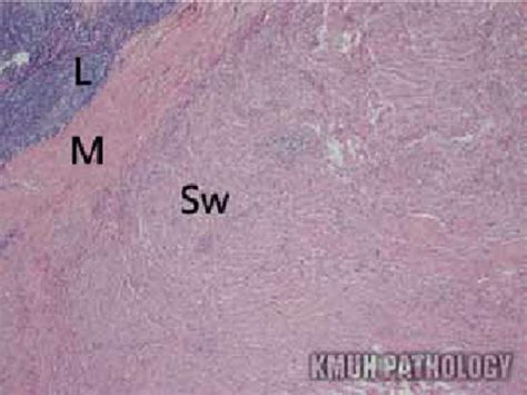 A Cuff Like Lymphoid Aggregate Was Recog Nized Peripheral To The Tumor