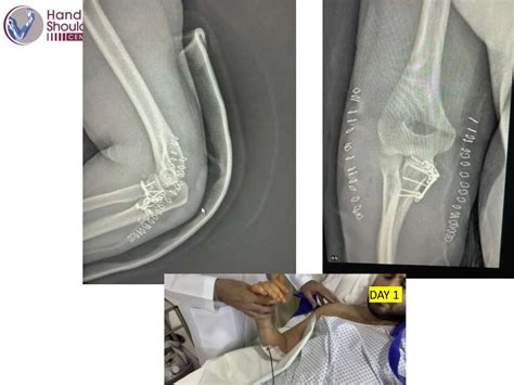 Coronoid Fracture Fix Or Notpptx
