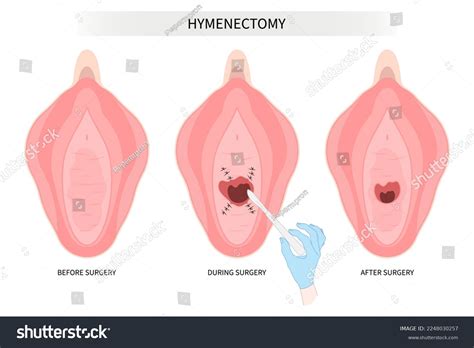 Surgery Procedure Medical Types Hymen Hymenoplasty Stock Vector