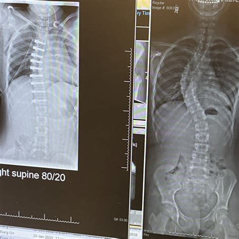 Patient Story Simrena Atwal Patient Story Setting Scoliosis Straight