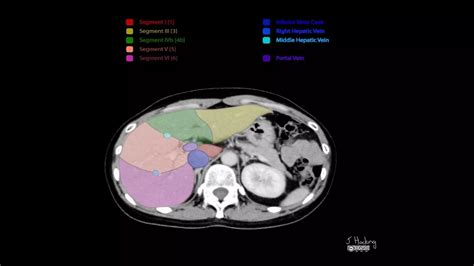 Liver Ct Anatomy 2pptx