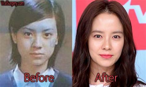 Song Ji Hyo Plastic Surgery Before And After Jaw Surgery Rumor Pictures