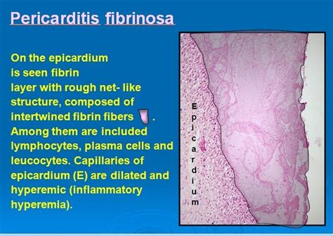 Pericarditis Types Causes Treatment Zdrave Bgeu