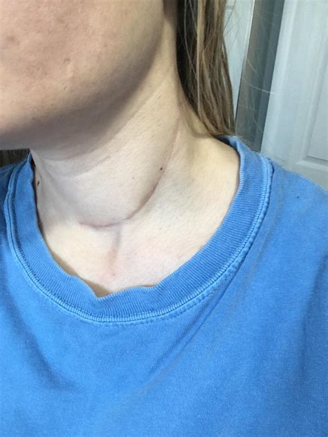 My Scar 3 Months Post Surgery Total Thyroidectomy And Neck Dissection