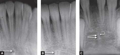 Nutrient Canal Radiograph