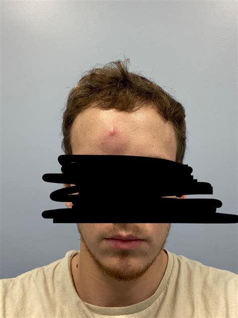 Forehead Hyperpigmentation Rskincareaddicts