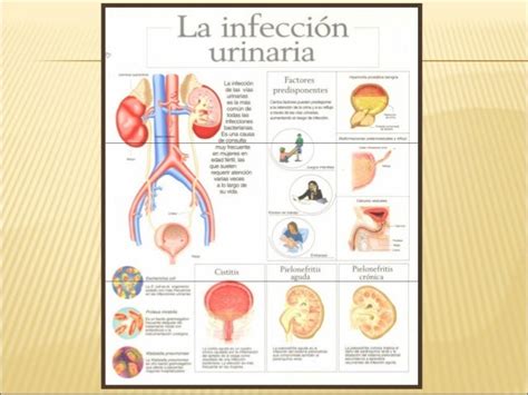 ¿qué Es Y Por Qué Se Produce La Infección Urinaria Qizr