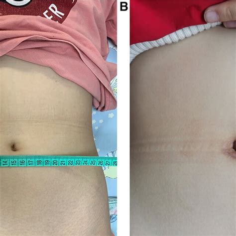Appearance Of A Single Incision And The Placement Of Robotic