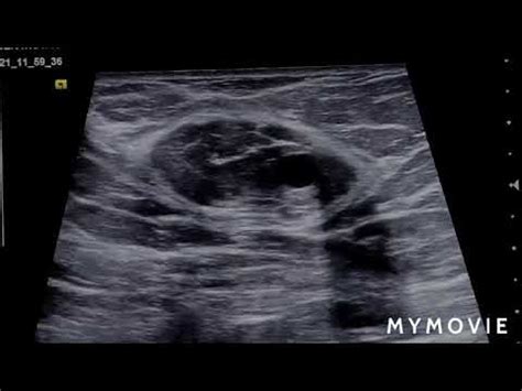 Breast Hamartoma • Ultrasound Case Youtube