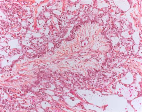 Testicular Germ Cell Tumors Human Pathology Photos