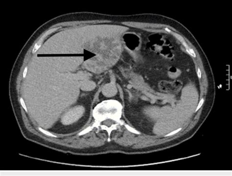 Axial Computed Tomography Ct Image Of The Abdomen Showing A Large