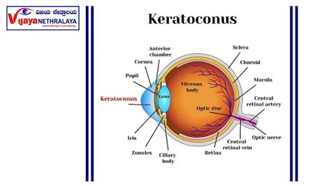 Signs Of Keratoconus What You Need To Know And Explore