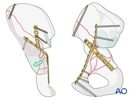 Orif Through Ilioinguinal Approach For Anterior Column And Posterior Hemitransverse
