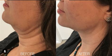 How Is Pdo Thread Lift Beneficial For Face Tightening