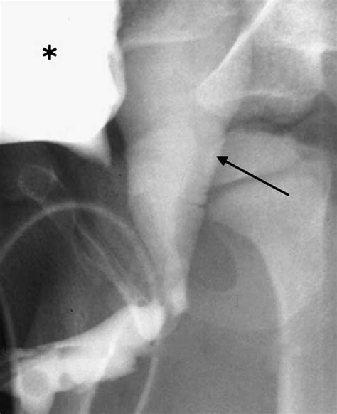 Enlarged Prostatic Utricle There Is Filling Of A Large Utricle Arrow