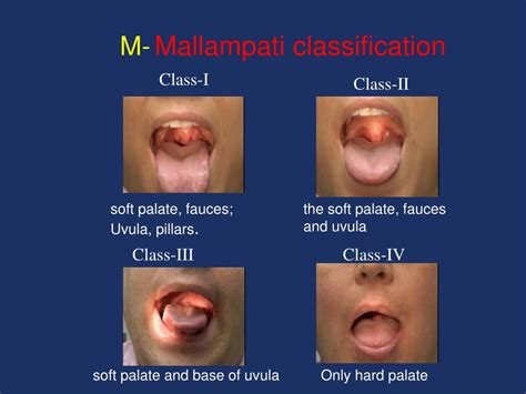 Ppt Difficult Airway Management Powerpoint Presentation Free