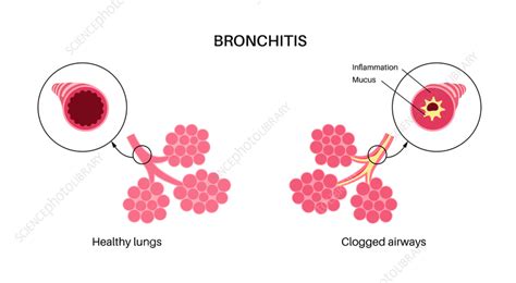 Bronchitis Lung Disease Illustration Stock Image F0402794
