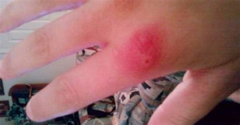 Qué Hacer Si Te Pica Un Ciempiés Escolopendra O Un Escorpión Alacrán