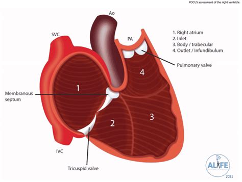 Pocus Series Right Ventricular Assessment With Emphasis On Tapse Apical And Subcostal Variants