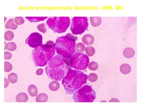 Acute Myeloid Leukemia Classification Pptx