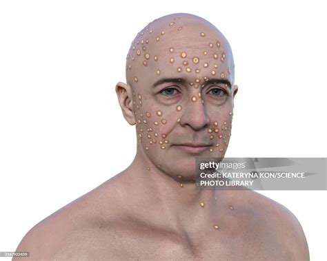 Man With Rash From Pox Virus Infection Illustration High Res Vector Graphic Getty Images