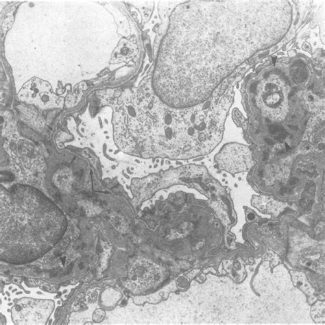 Electron Microscopy Of Glomerular Tuft Showing Subendothelial And