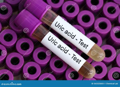 Labcorp Tube For Uric Acid At Tiffany Mora Blog