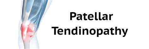 Patellar Tendinopathy Michiro