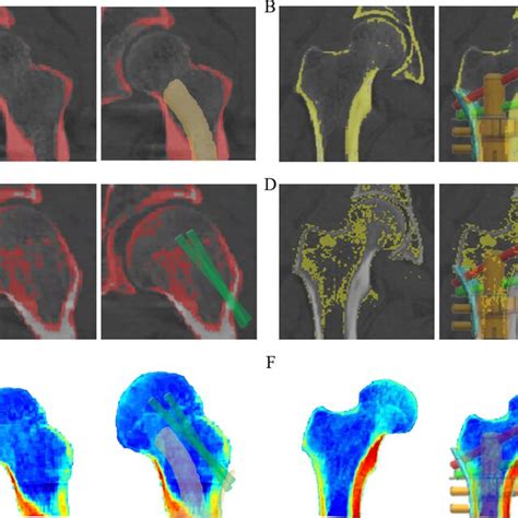 Illustration Of Hu Value Thresholding Fea And Intraoperative Surgical