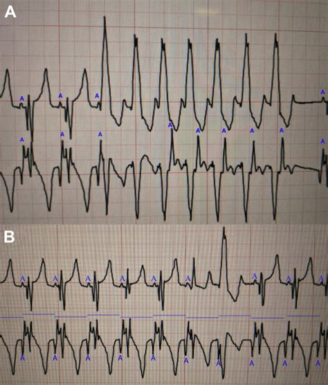 First In Human Use Of A Continuous Real Time Atrial Electrogram Monitoring Device After Cardiac