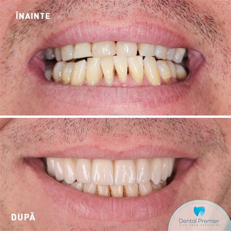 Lista Preturi Proteze Dentare Fixe Cu 4 Si 6 Implanturi All On 4 Si All On 6