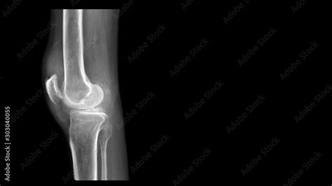 Film X Ray Knee Radiograph Show Os Fabella Fabella Is A Small Bone Embedded In Tendon This Is