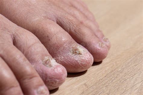 Cancer Chemotherapy Cause Swelling Of Ankles Ankle Oedema Skin To
