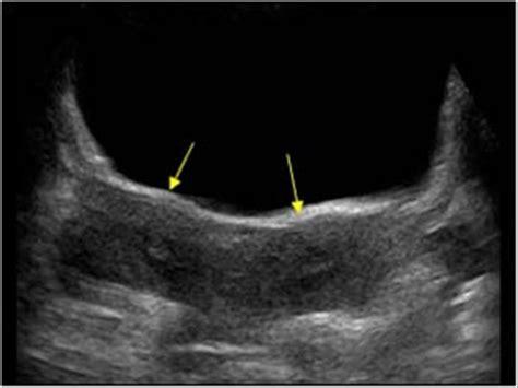 Bicornuate Uterus Pregnancy Ultrasound