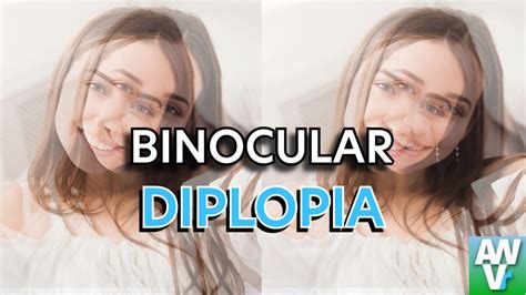 Binocular Diplopia Double Vision When Both Eyes Are Involved Equal Eyes