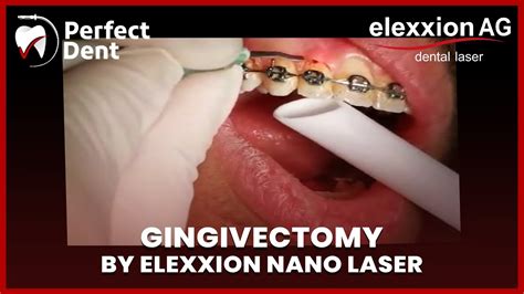 Ada Code For Laser Gingivectomy At Donna Willey Blog