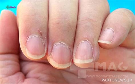 Causes And Treatment Of Peeling Around The Nail پرتو نیوز