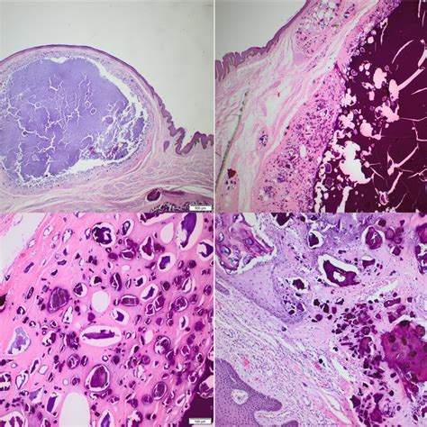 Firm Flesh Colored Nodules Within The Scrotal Dermis Before And After Download Scientific