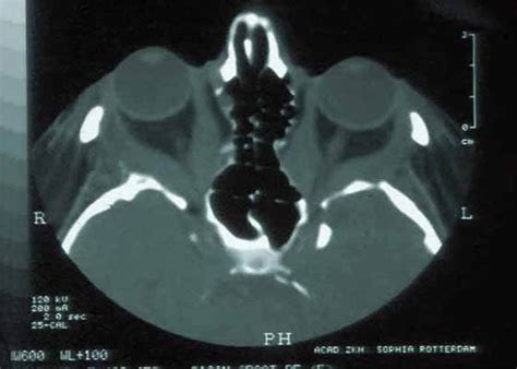 Our Results Orbital Decompression The Elza Institute