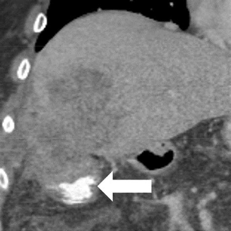 49 Year Old Female With Metastatic Intrahepatic Cholangiocarcinoma A