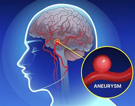 Early Warning Signs Of Brain Aneurysm What It Is Why It Happens And