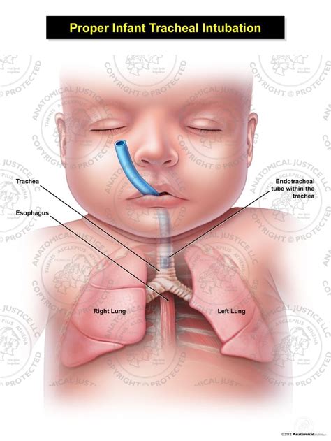 Proper Infant Tracheal Intubation