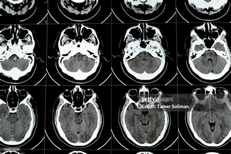 Multi Slice Ct Scan Of The Brain Showing Large Brain Stem And Right