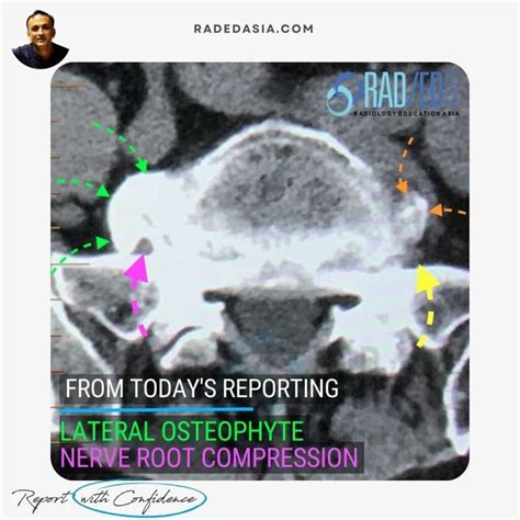 Ct Lumbar Lateral Osteophyte Causing Nerve Compression Radiology Education Asia
