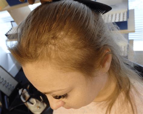 Diffuse Thinning Causes Symptoms And Treatment The Hair Loss Centre