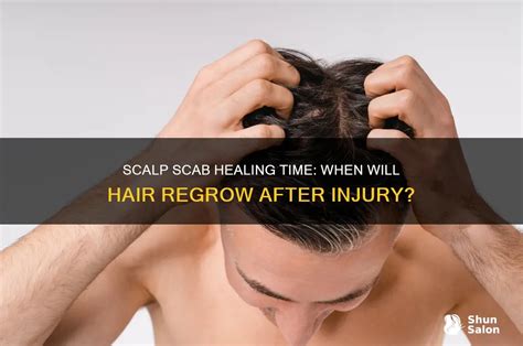 Scalp Scab Healing Time When Will Hair Regrow After Injury Shunsalon