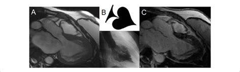Apical Hypertrophic Cardiomyopathy Parietal Hypertrophy Predominantly