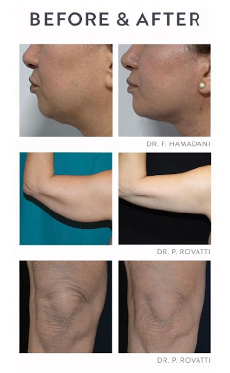 Before And After Ruxer Medspa