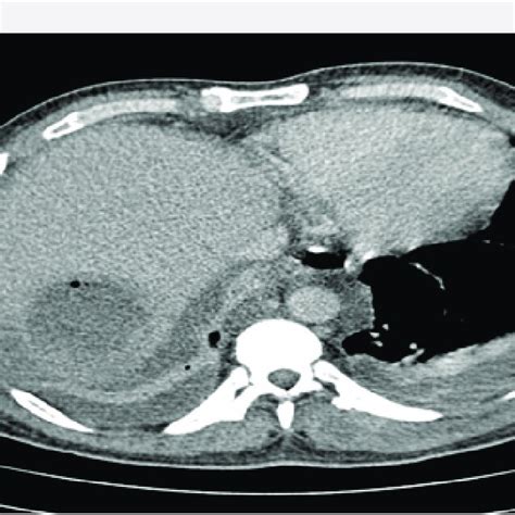 Liver Abscess In The Left Lobe Poorly Defined Walls Presence Of Download Scientific Diagram
